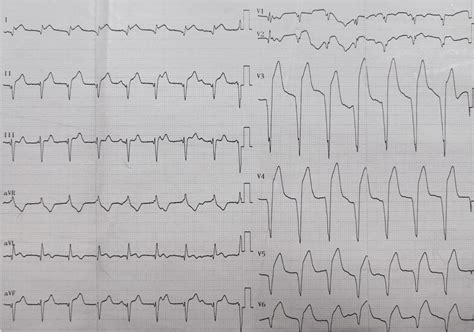 Diffuse Lad And Lv Thrombus As Possible Manifestation Of Protein S Deficiency In A Young Patient