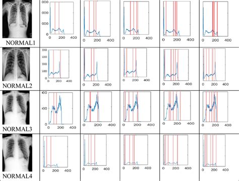 Histogram For NORMAL Images Experiments For Proposed Technique In Download Scientific Diagram