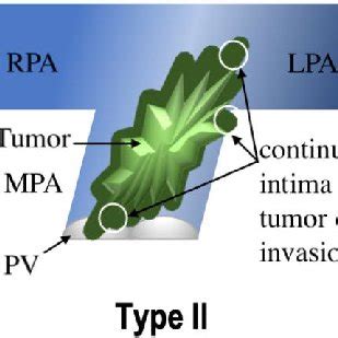Illustration Of Three Types Of PV Involvement Three Types Of PV Download Scientific Diagram