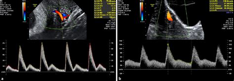 Figure 1 From Uterine Artery Pulsatility Index Assessment At