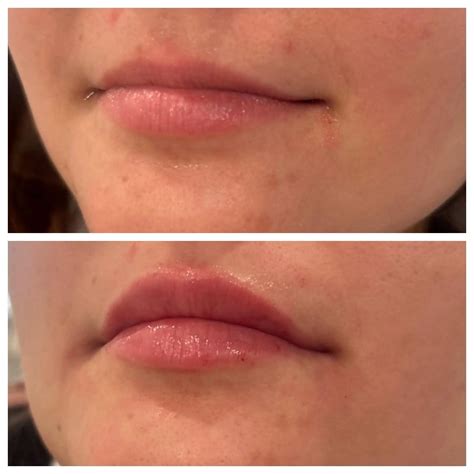 Lip Filler Before And After Best Lip Injection Treatment
