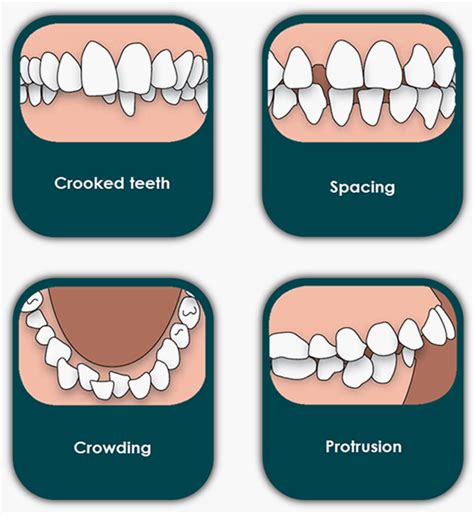 Magic Braces Auckland Smilefast City Dental Lounge