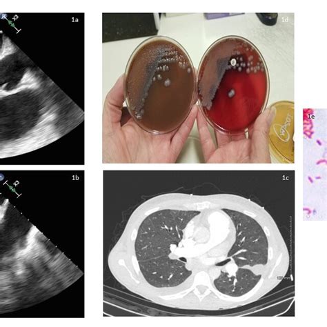 A B Echocardiogram Showing Vegetation On The Bioprosthetic Mitral Download Scientific Diagram