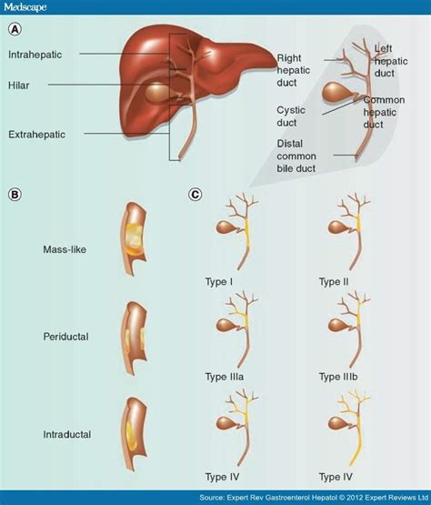 How Does Perihilar Cholangiocarcinoma Present In Patients And What Are
