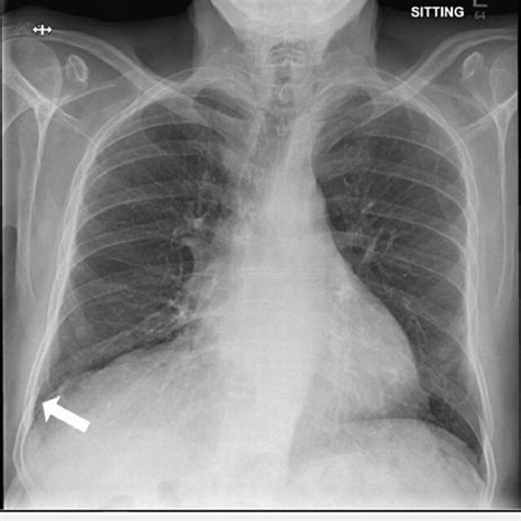 Right Lower Lobe Atelectasis Chest X Ray At Marianne Holt Blog