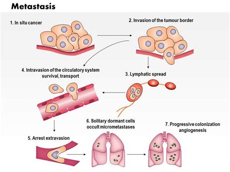 Metastasis Diagram