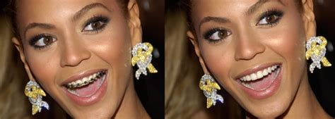 Did Beyonce Have Braces The Truth Proof Braces Journey