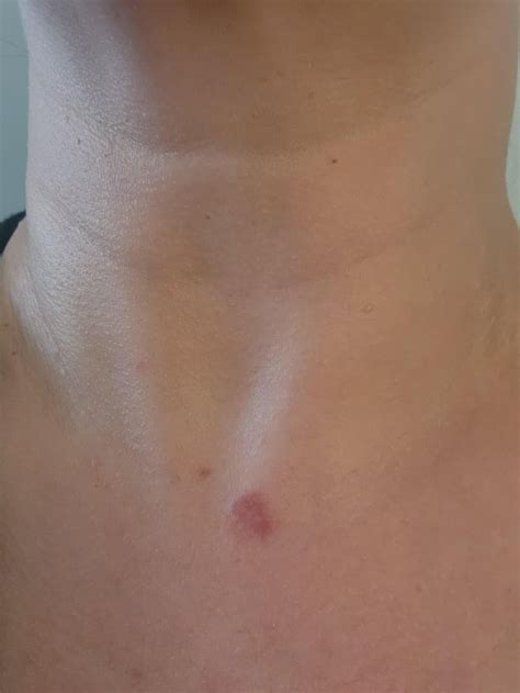 Red Mark On Neck R Dermatologyquestions