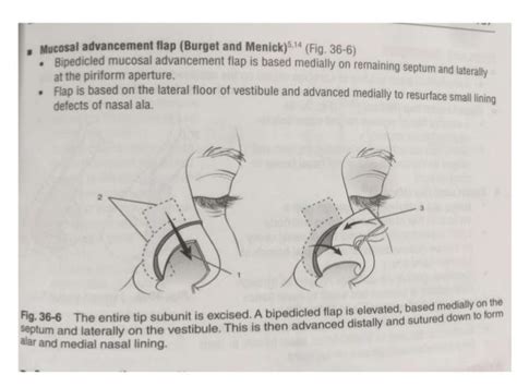 Nose Reconstruction