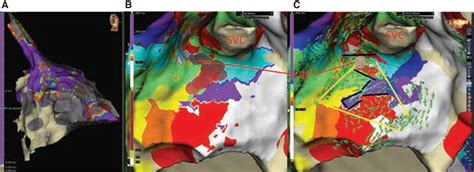 Figure 1 From Elucidation Of Complex Atrial Tachycardia Activation In A