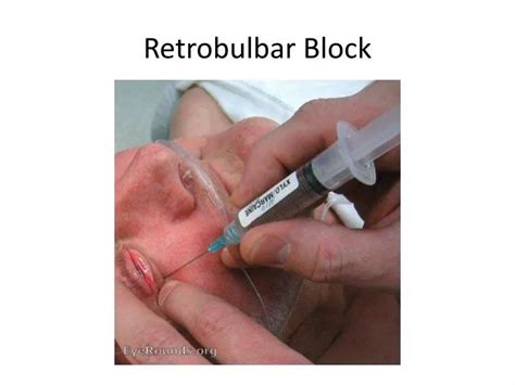 Ppt Retrobulbar Block Powerpoint Presentation Free Download Id2243163