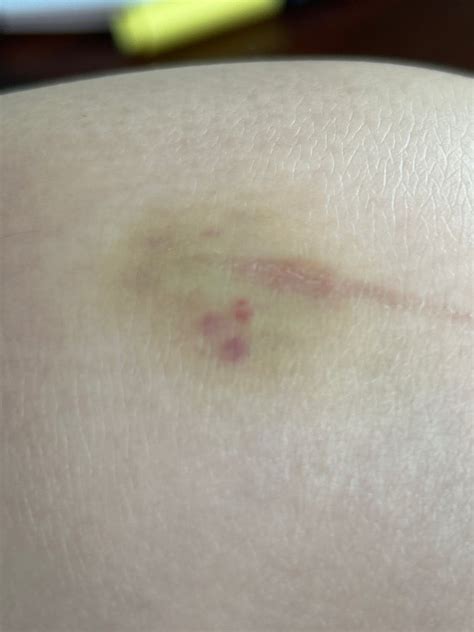 상처 삼각형 지식in