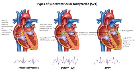 Supraventricular Tachycardia Svt Dr Hari Sugumar