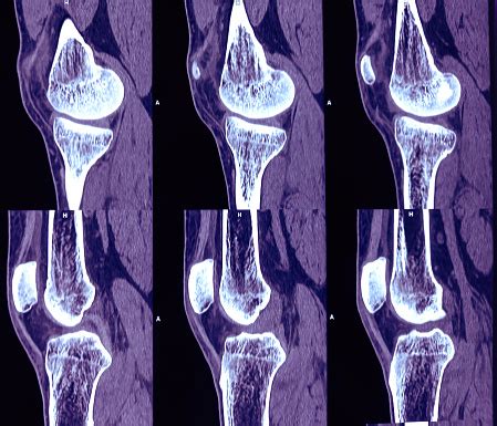 Ct Scan Of Knee Joint Knee Joint Alignment And Congruity Maintained