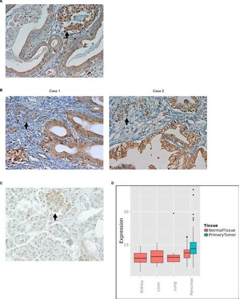 Overexpression Of Podxlitgb1 And Bcl7bitgb1 Accurately Predicts