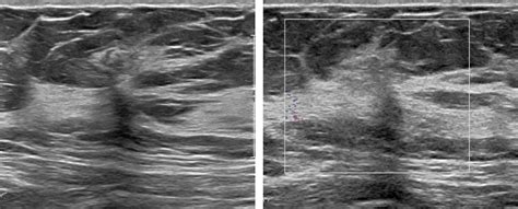 radial sclerosing lesions radiology ucla health