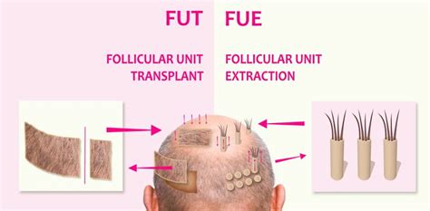 Fue Vs Fut Which Hair Transplant Method Is Better Viral Rang