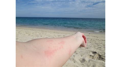 First Aid Treatment For Jellyfish Stings