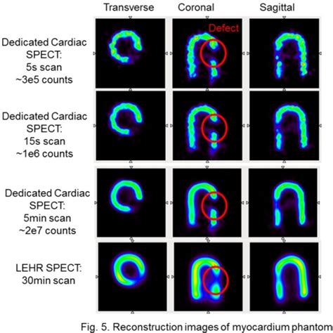 Spect Scan Heart
