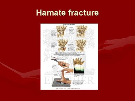 Wrist And Hand Injuries Anatomy Bones Joints Ligaments