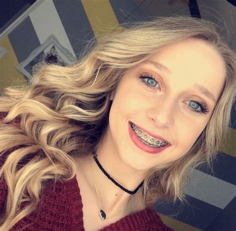 Pin On Braces