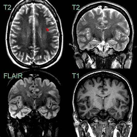 Focal Cortical Dysplasia Fcd Neuroradiology