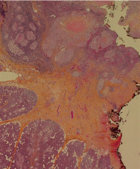 Parotid Gland Bottom With Adjacent Subcutaneous Lymph Nodes Showing Download Scientific