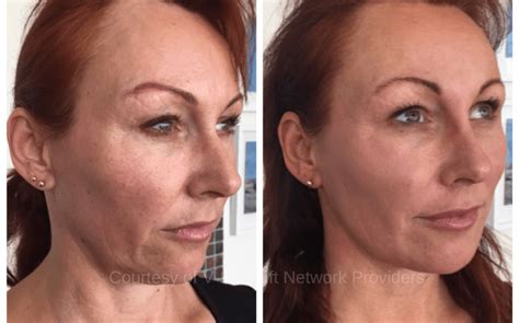 V Soft Lift The Latest In Pdo Threads Visit New Youth Medical Spa