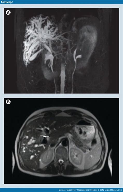 Management Of Perihilar Cholangiocarcinoma Page 5