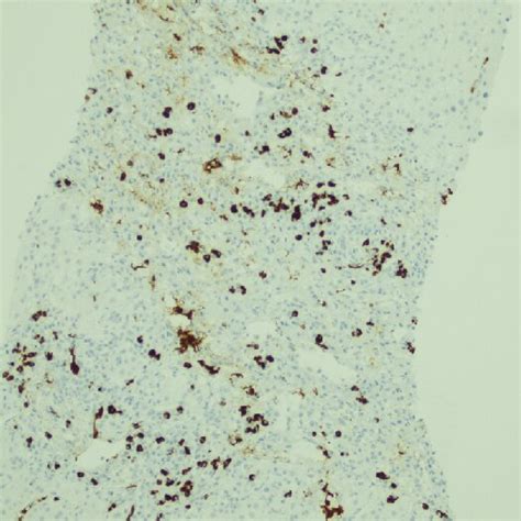 Cd 138 X 400 Immunohistochemical Stain For Cd138 Highlights The
