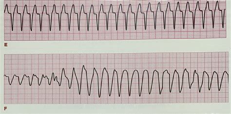 hospitalist conducting a code blue in the hospital with acls algorithms hospitalist x acls