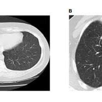 A Lung Image CT Normal B Lung Image CT Abnormal Download Scientific Diagram