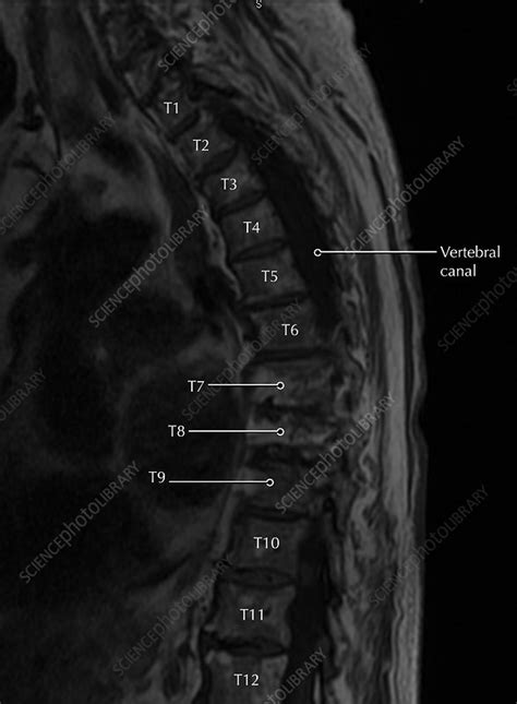 Thoracic Vertebrae Compression Fracture Stock Image C027 1216 Science Photo Library