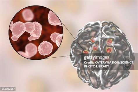 Cryptococcal Brain Lesions Illustration High Res Vector Graphic Getty Images