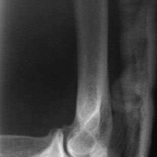 Intraosseous Ganglion Cyst Of Olecranon Request PDF