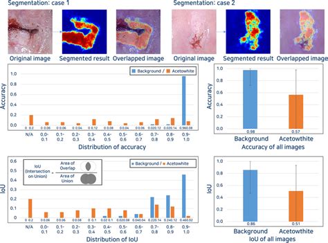Segmentation Performance Of Segnet For Acetowhite Lesion Download