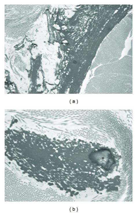 Histopathology Of Pseudoxanthoma Elasticum And Related Disorders Histological Hallmarks And