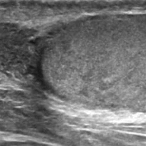 Normal Epididymis Longitudinal Us View Shows Normal Head Of Epididymis Download Scientific