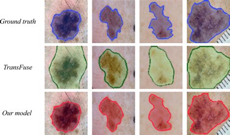 The Visualization Results On The Skin Lesion Segmentation Tasks Gt Download Scientific Diagram
