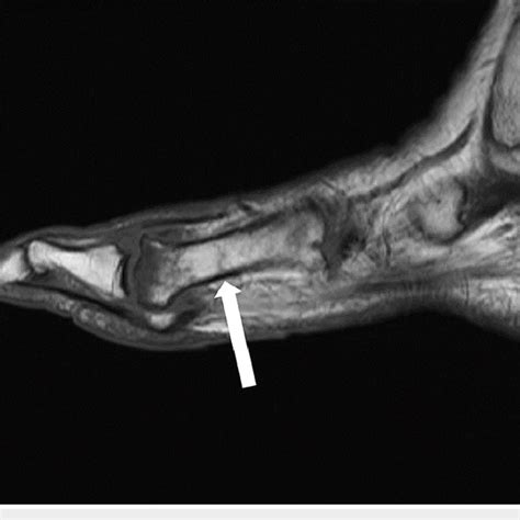 T1 Weighted Sagittal Mri Of The Right Foot Demonstrating A First