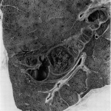 Cylindrical Bronchiectasis Pressure Fixation Barium Sulphate Download Scientific Diagram