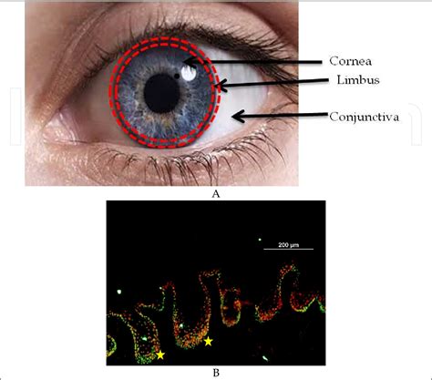 Figure 1 From Limbal Stem Cell Transplantation And Corneal Neovascularization Semantic Scholar