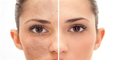 How To Get Rid Of Acne Marks Naturally HowRid 1853