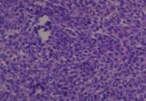 Novus Biologicals™ Human Esophageal Tissue Microarray Cancer Human