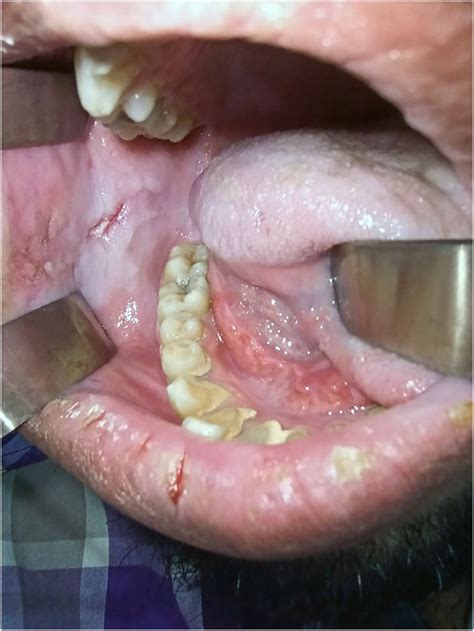 Drug Induced Erythema Multiforme Oral Variant A Case Report Pocket Dentistry