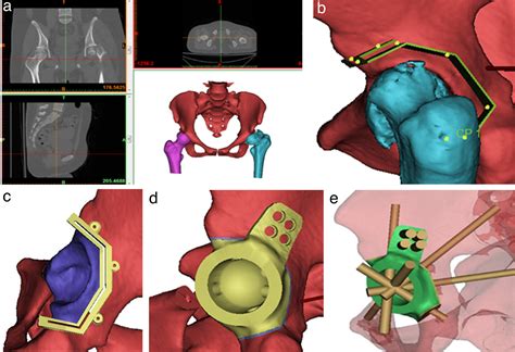 Clinical Outcomes After Extra Articular Resection Of Hip Joint Tumour