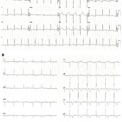 A Electrocardiogram At Admission Revealing A Discrete St Segment Download Scientific Diagram