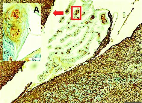 Histopathological Appearance Of Choroid Plexus With A Corpuscle Like Download Scientific