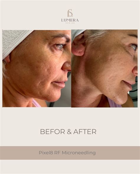 Rf Microneedling Nyc Pixel8 Lumera Skin Lab