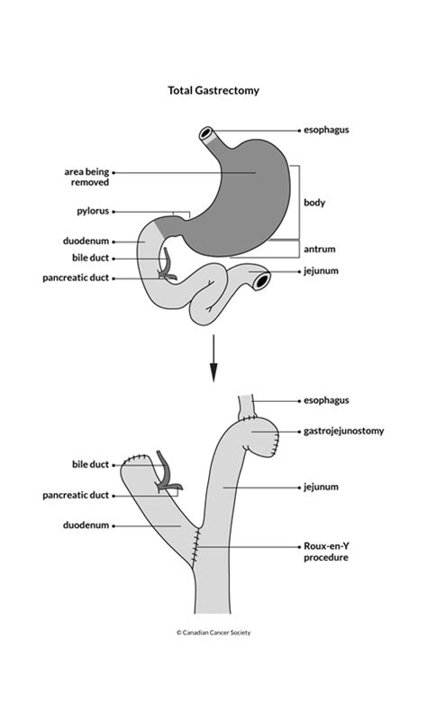 Total Gastrectomy For Stomach Cancer